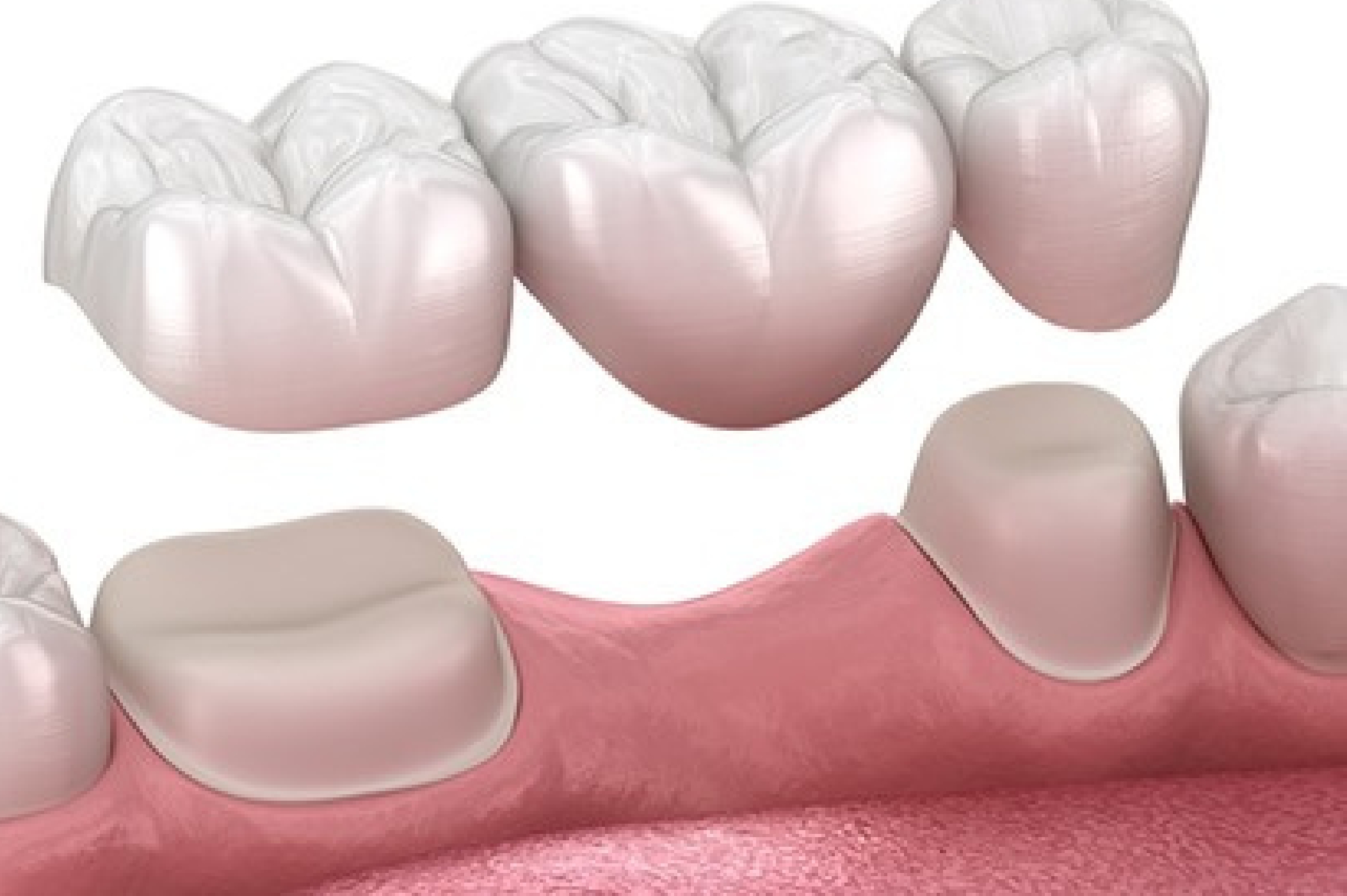 Crown & Bridge Dental Care | Hyderabad’s Best